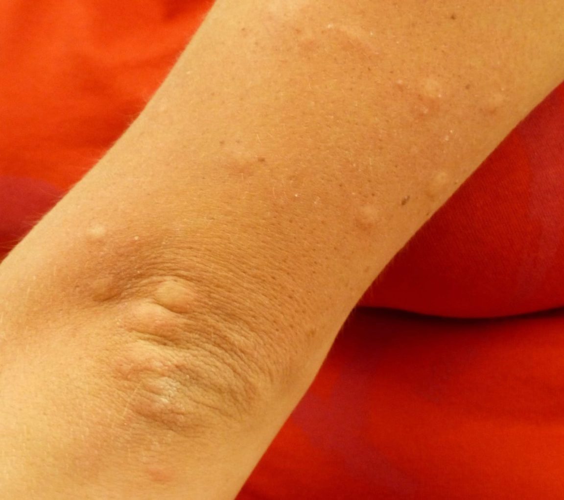 ยาที่ต้องระวัง หากมีประวัติแพ้ยากลุ่มซัลฟา(Sulfa Drug Allergy)